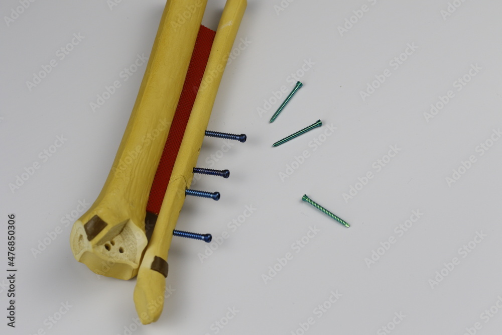Surgical instruments for operation bone fractures Stock Photo | Adobe Stock