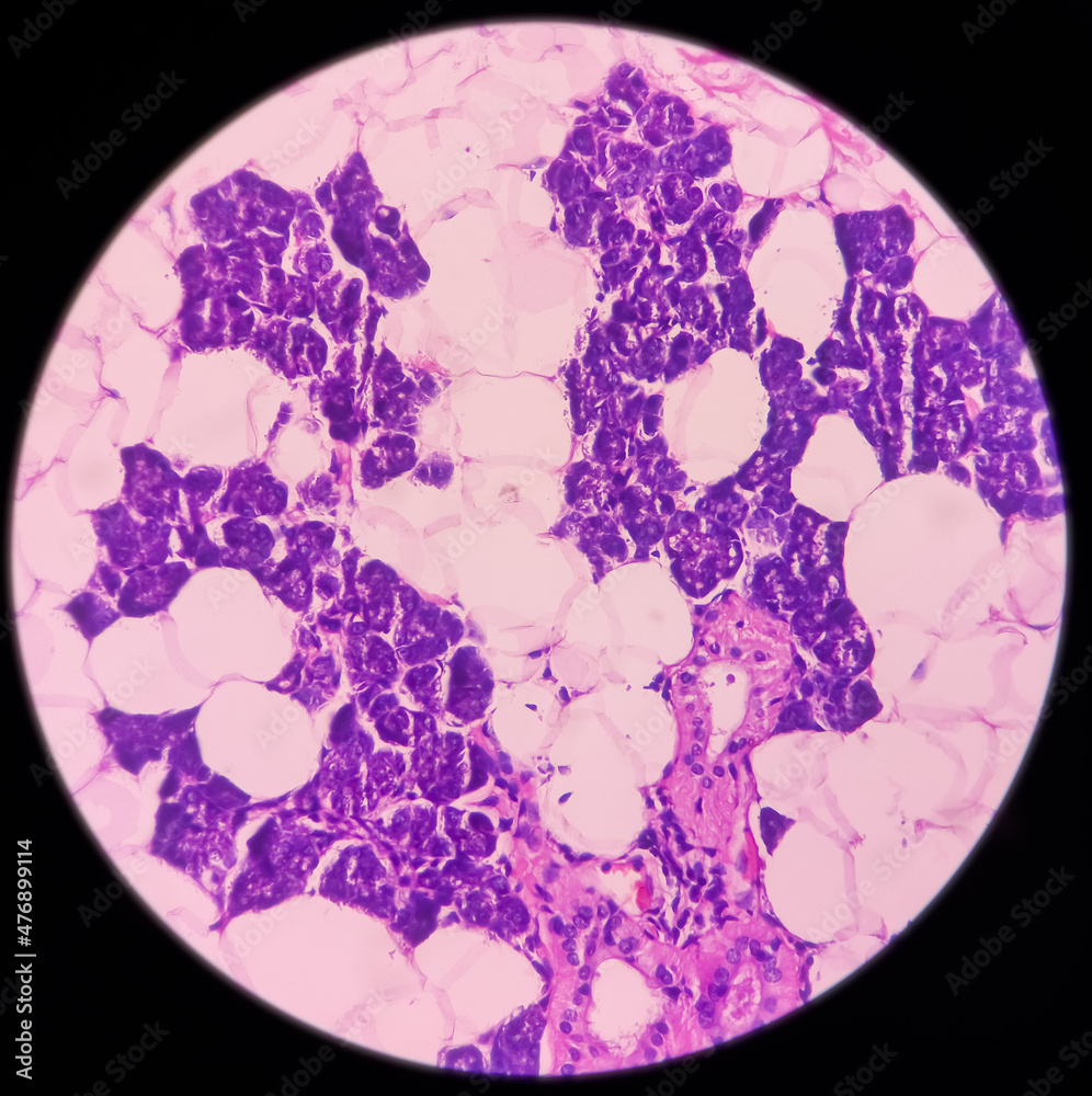 Parotid tumor: Pleomorphic adenoma, benign neoplasm, composed of ...