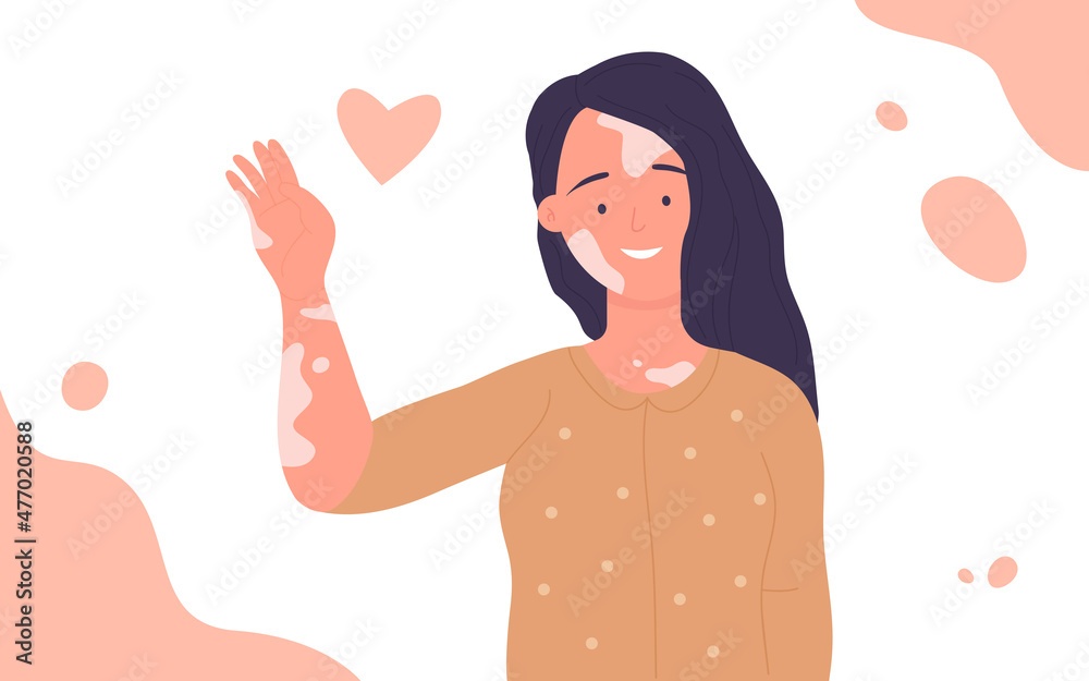 Girl with skin problems vitiligo vector illustration. Cartoon young ...