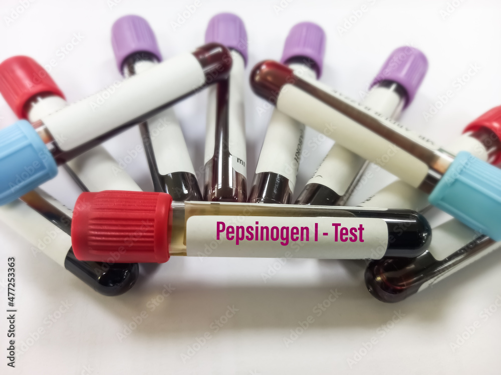 Blood sample tube for Pepsinogen I test. To diagnosis Gastric cancer ...