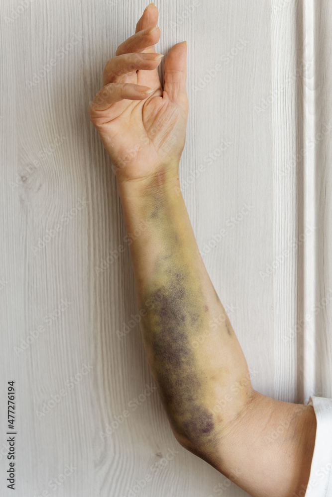 Severe arm bruising after coronary angioplasty Stock Photo | Adobe Stock