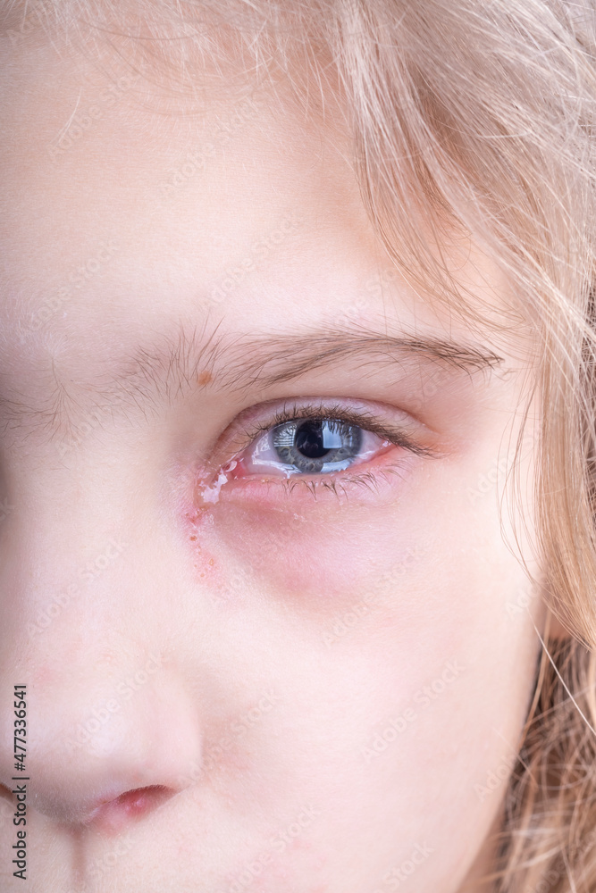 close-up. a girl with white hair. a tear flows from the eye, it is red ...