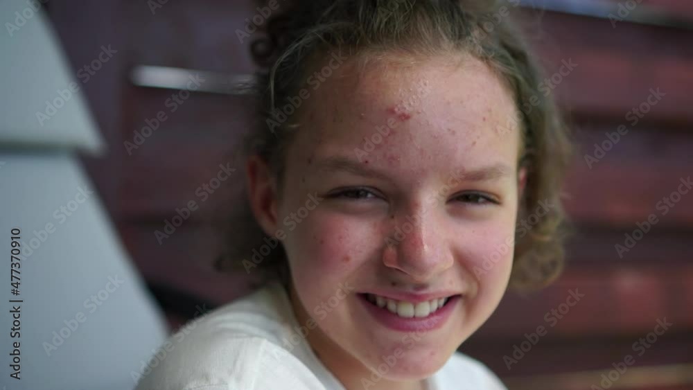 Close up portrait of a smiling bright teenage girl with teenage rashes ...