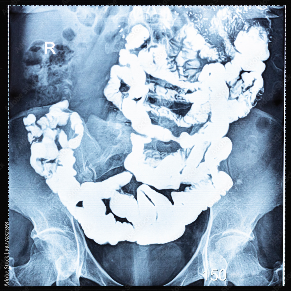 X-ray radiogram with Barium study of small bowel after 150 minutes (two ...