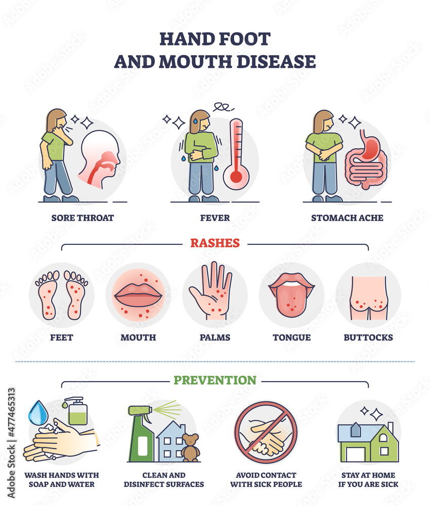 Hand, foot and mouth disease with rashes and how to avoid outline ...