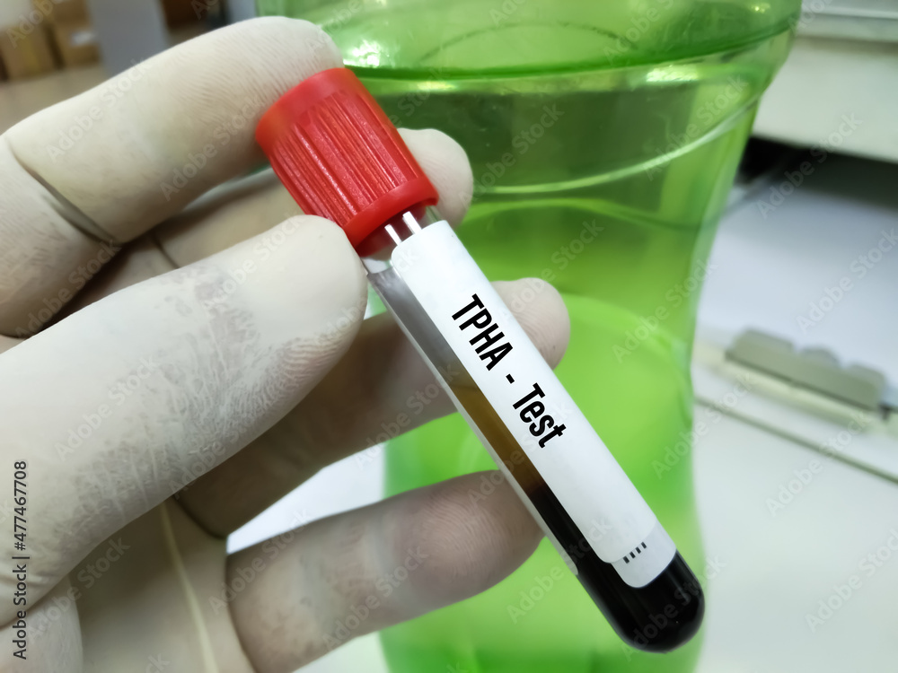 Blood sample for Syphilis, Treponema pallidum haemagglutination (TPHA ...