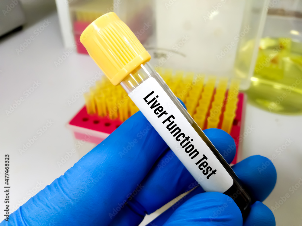 Inflammatory breast lump, Chronic nonspecific mastitis with fibrocystic ...