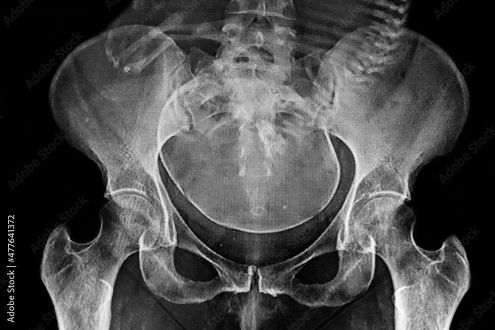 X- ray image of a pelvimetry. Medical themes Stock Photo | Adobe Stock
