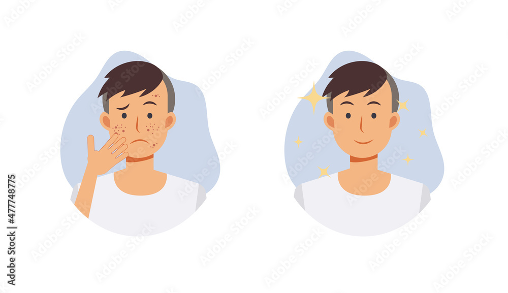Skin care concept.Before and after acne treatment procedure.A man with ...