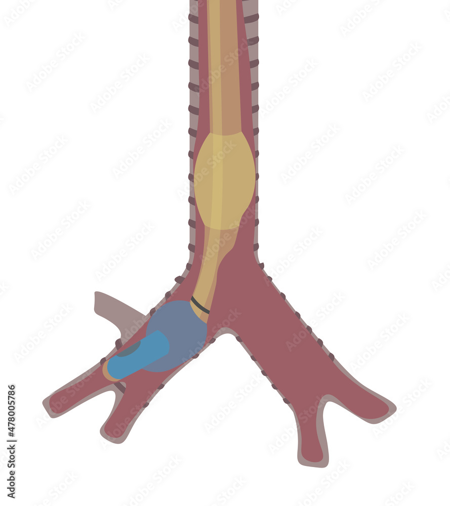 Independent lung ventilation illustration of a right doble lumen tube ...