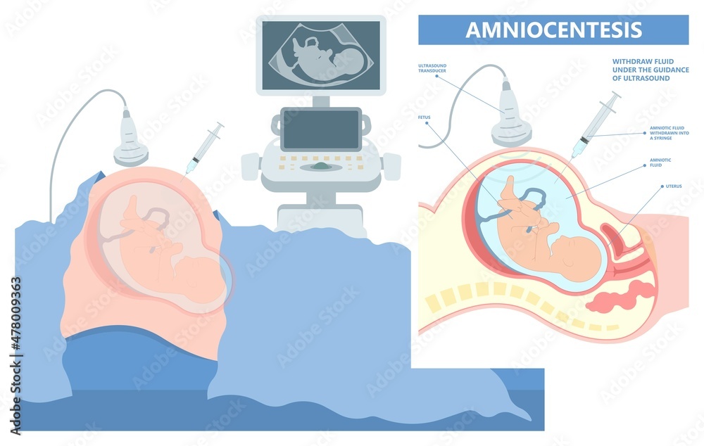Amniocentesis diagnostic test treat LAB analysis DNA gene screen risk ...
