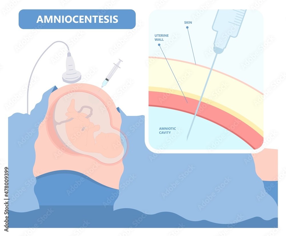 Amniocentesis diagnostic test treat LAB analysis DNA gene screen risk ...