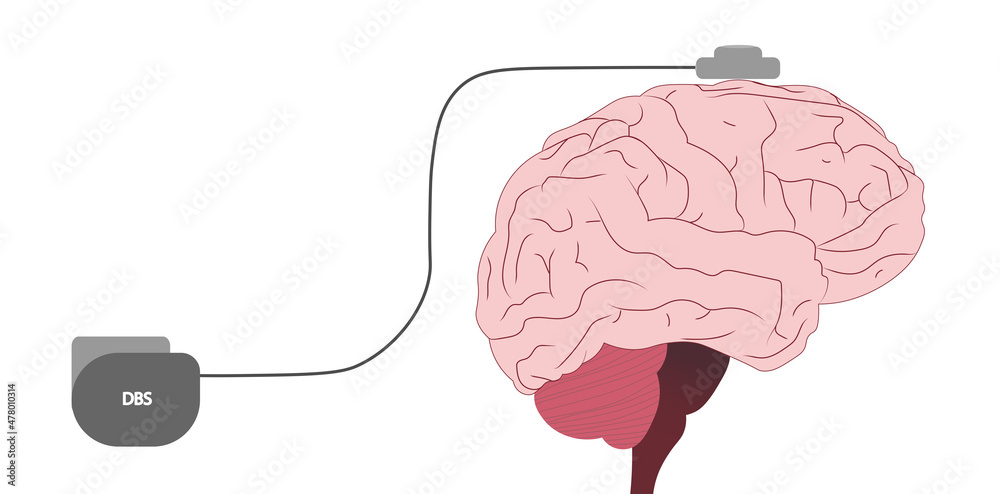Deep brain stimulation (DBS) illustration. Electrodes placement for ...