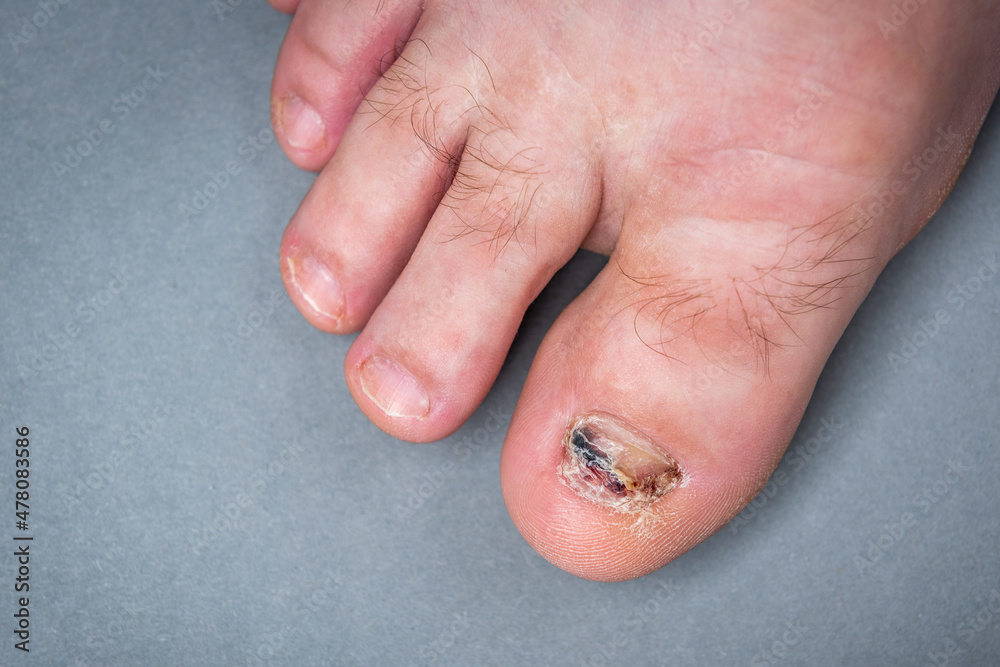 Onychomycosis fungal infection of toenail. Sick nail on the foot after ...