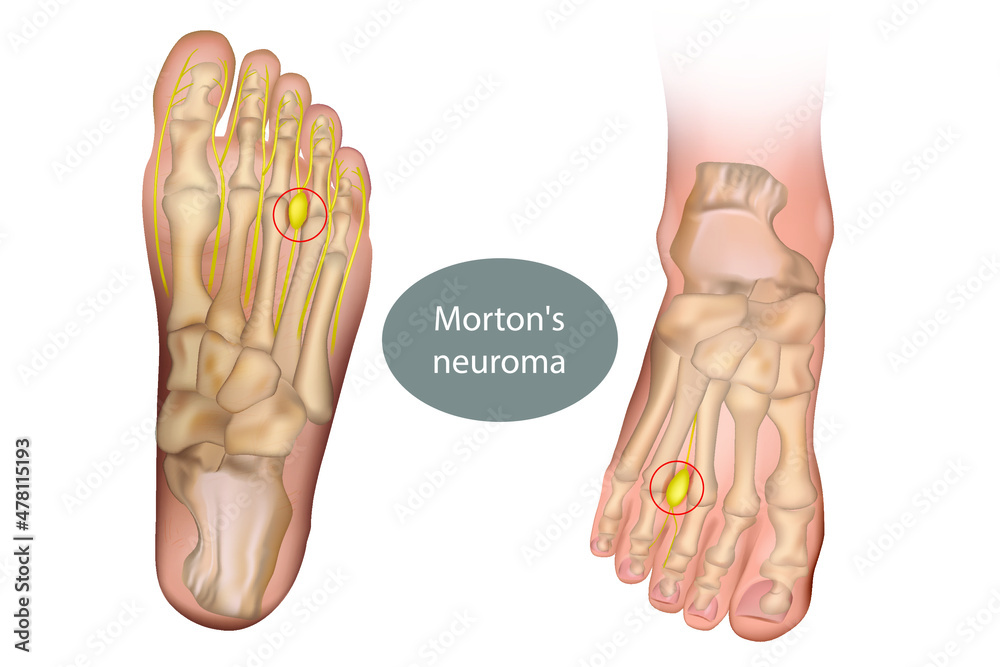Morton neuroma, Morton's metatarsalgia, Intermetatarsal neuroma, and ...