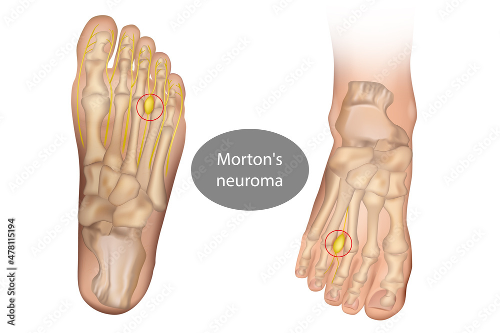 Morton neuroma, Morton's metatarsalgia, Intermetatarsal neuroma, and ...