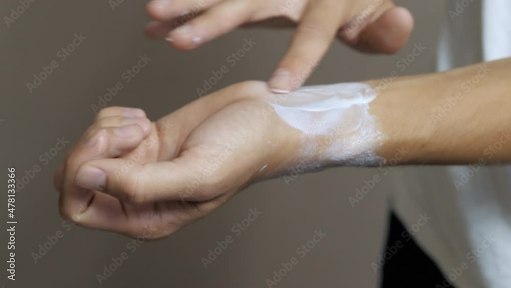 Close-up of smearing healing cream a bruise on the hand, a sprain and a ...