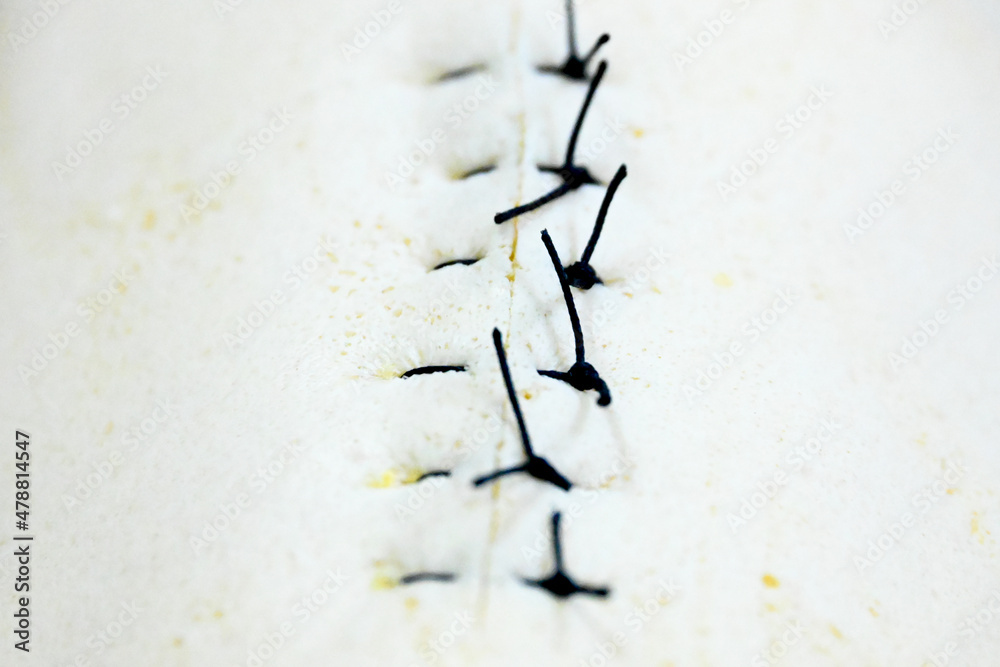 Interrupted Vertical Mattress Surgical Suture Stock Photo | Adobe Stock