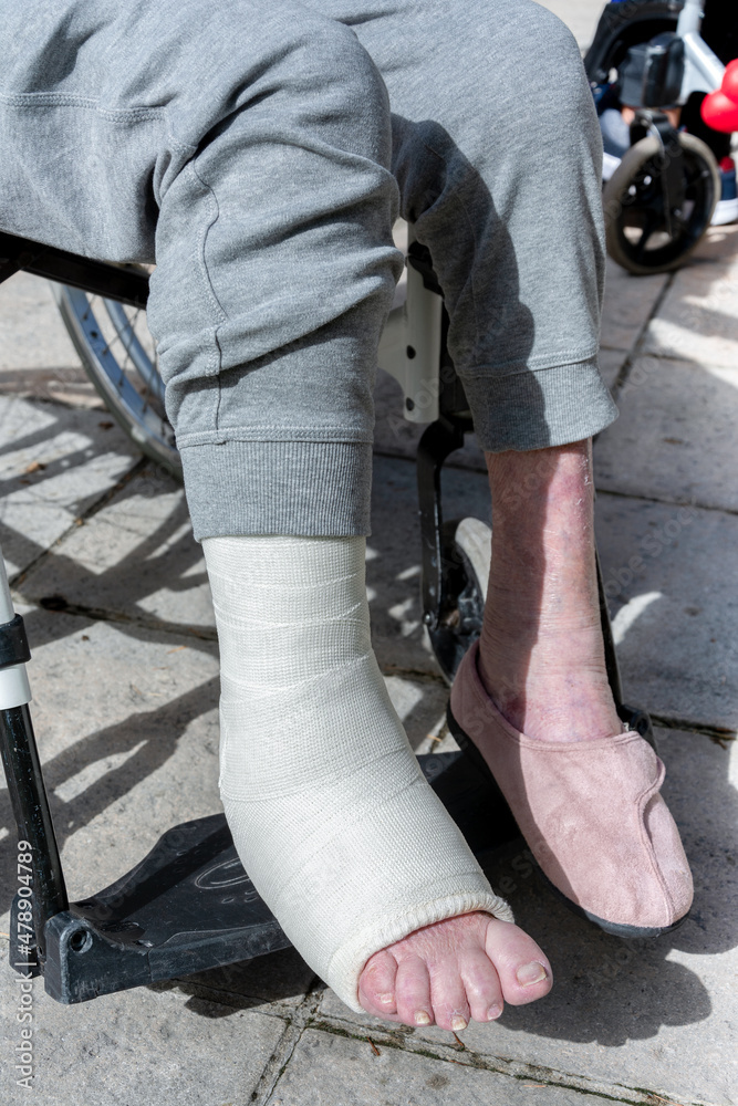 Cheville plâtrée sur une personne âgée. Fracture de la malléole. Plan ...