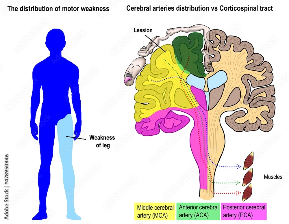 The different pattern of motor weakness according to the different ...