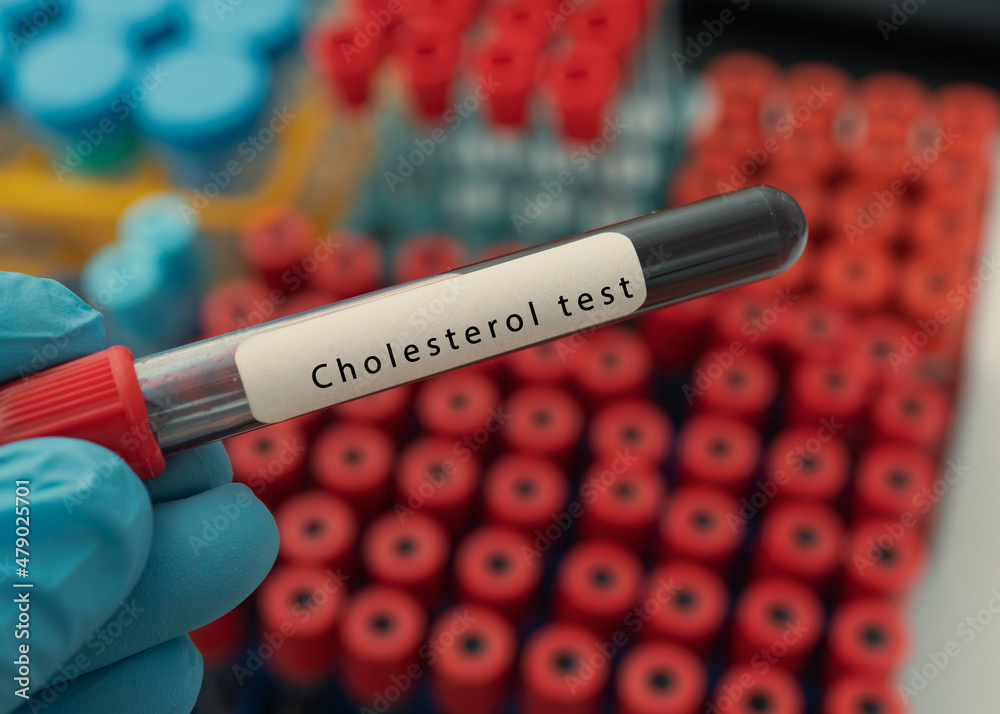 Blood sample tube with abnormal high cholesterol test Stock Photo ...
