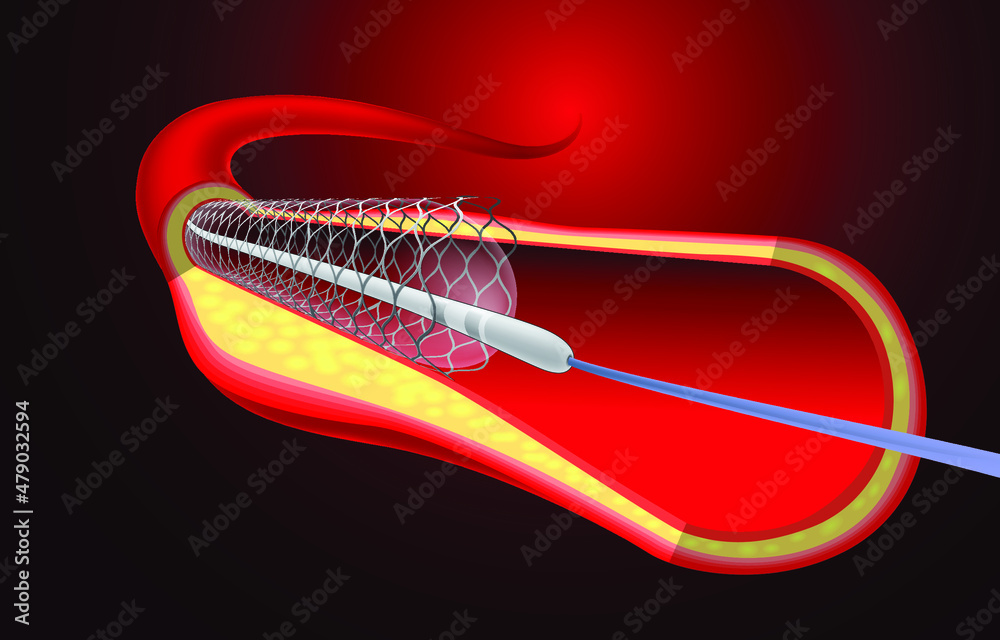 Medical and educational illustration of stent implantation to support ...