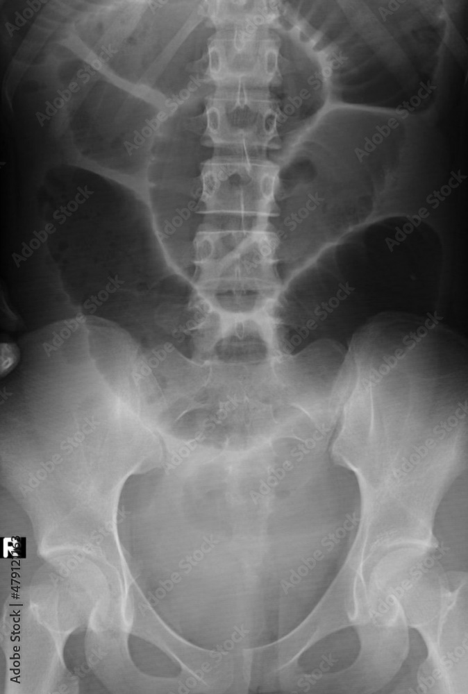 x ray of a bowel dilatation ,small bowel obstruction,small intestine ...