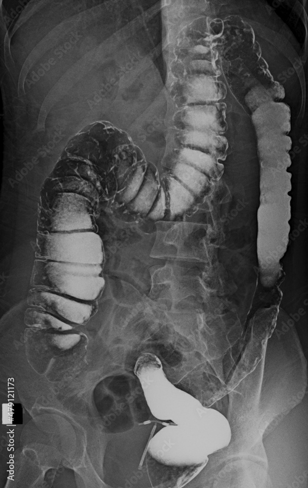 Barium enema normal anatomy x ray contrats study Stock Photo | Adobe Stock
