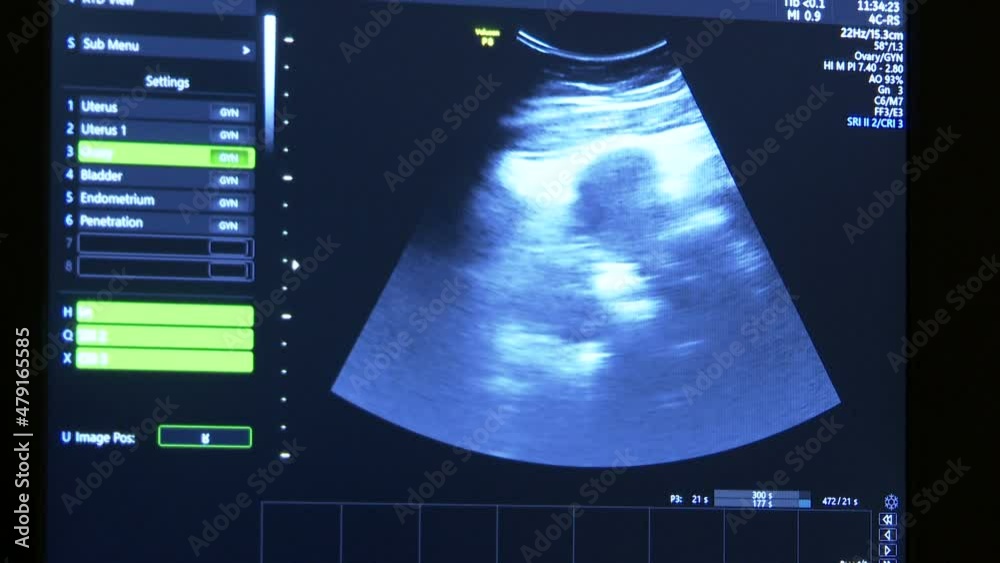 Sonography. The screen of the ultrasound machine. Results of the ...