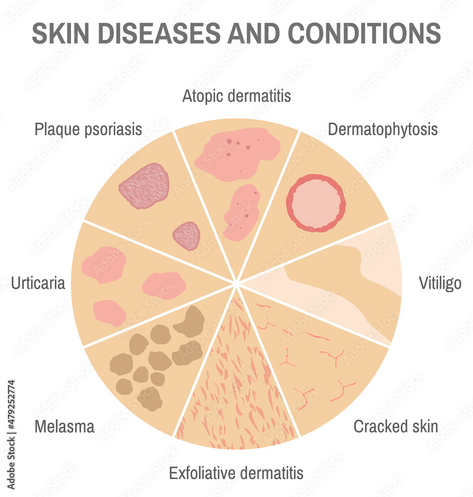 Colorful circle diagram infographic of skin diseases and conditions for ...