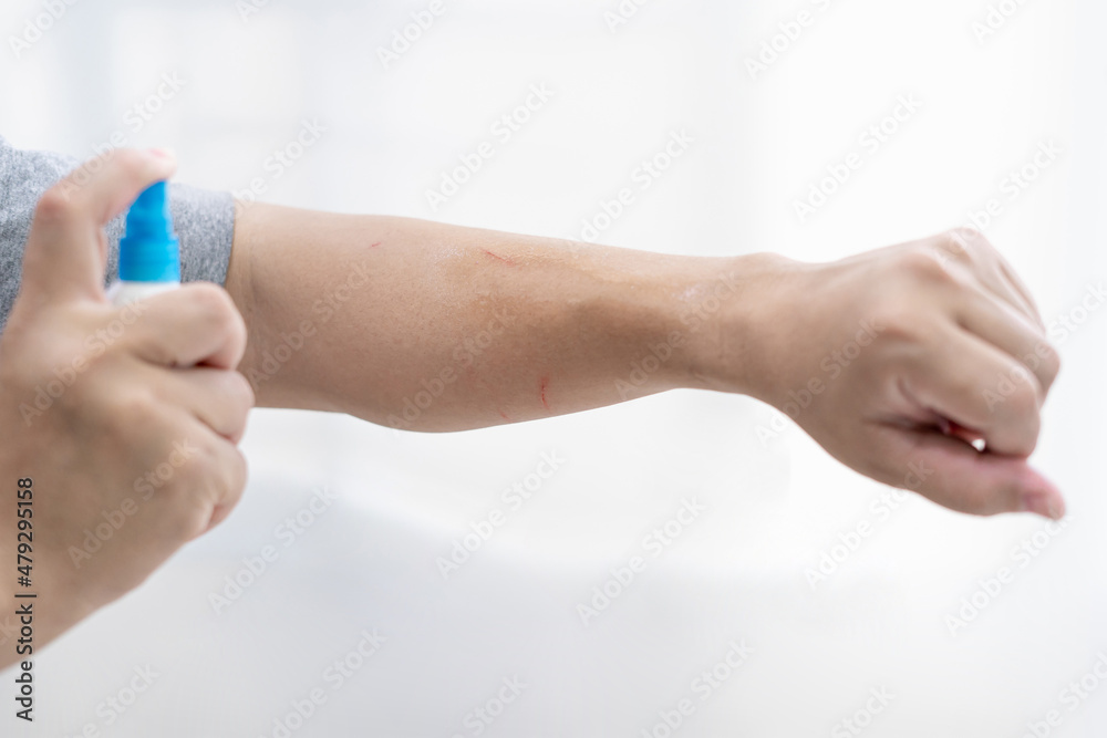 Close up arm of man and use spraying alcohol on a cat scratch wound ...