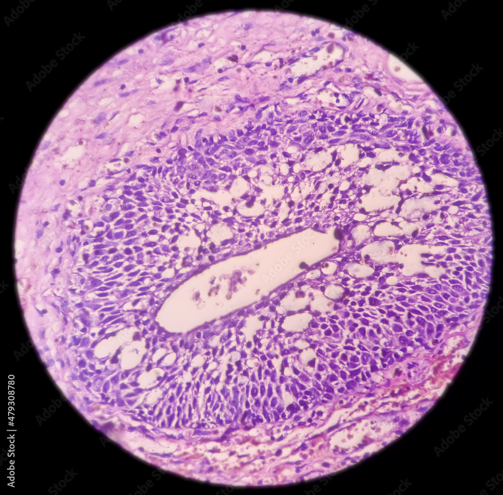 Tissue from endometrial polyp: Ovarian polyp, show myomatous polyp ...