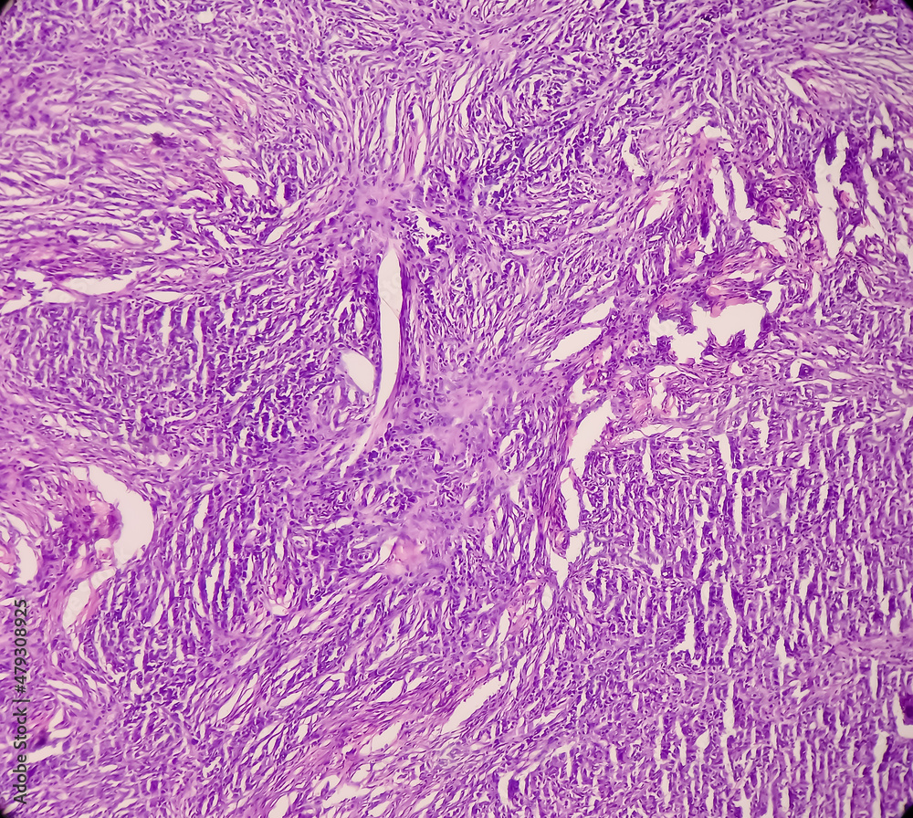 Tissue from scalp: tumors of Skin, microscopic image of a ...