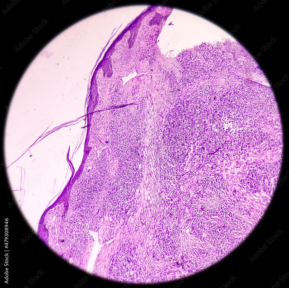 Tissue from scalp: tumors of Skin, microscopic image of a ...