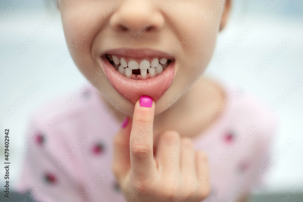 A child girl shows her mouth without one missing tooth in close-up ...