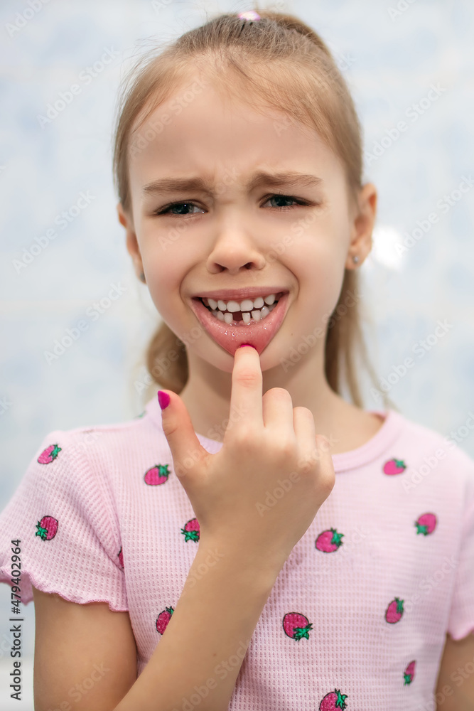 A child girl shows her mouth without one missing milk tooth and suffers pain. The first milk ...
