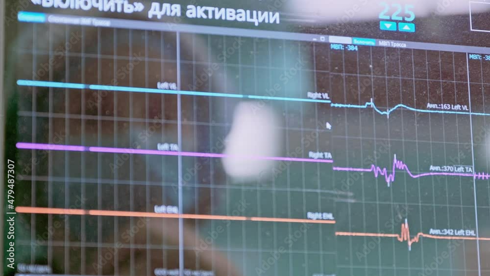 Screen of a monitor showing vital signs of a patient Stock Video ...