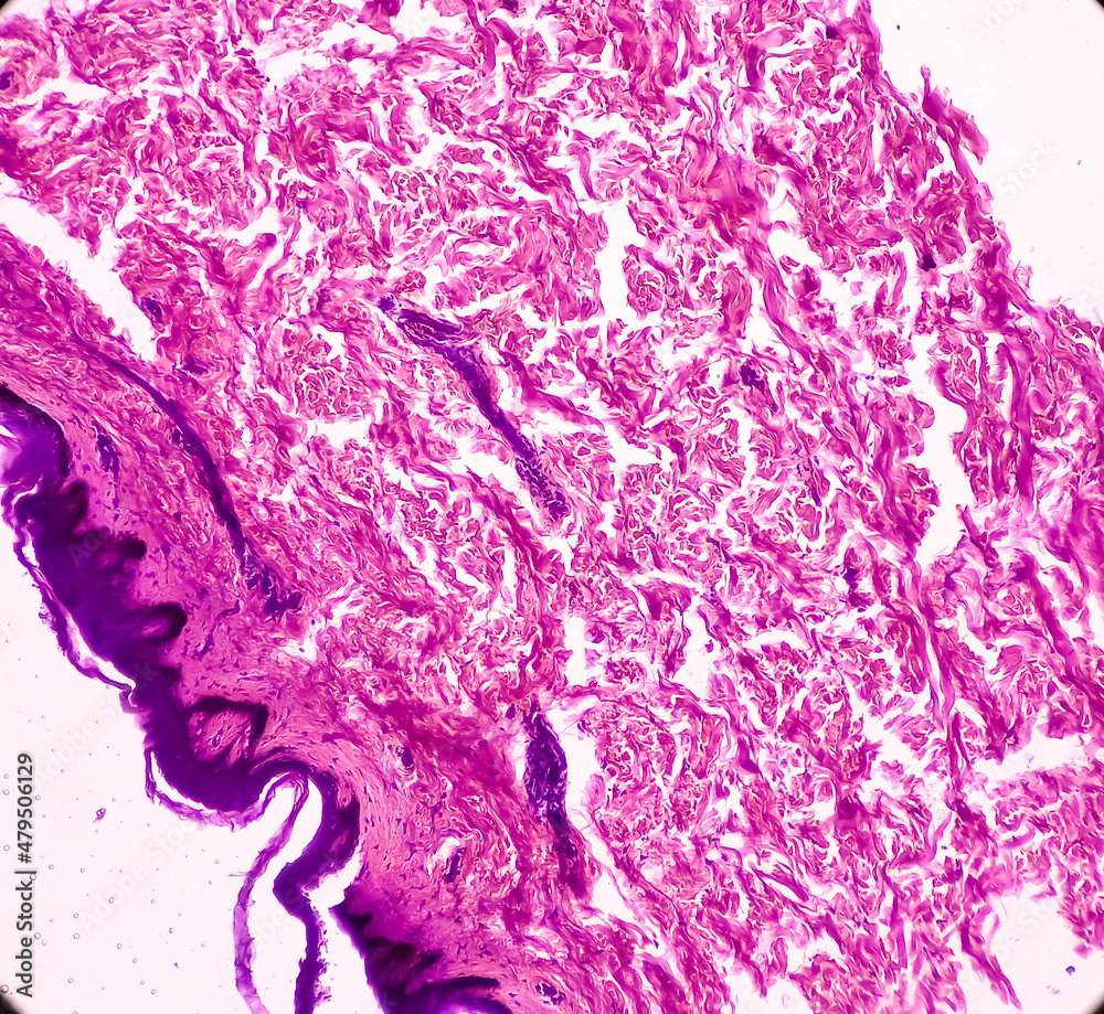 Chest Wall Cystbiopsy Epidermal Inclusion Cyst Commonly Called Sebaceous Cyst Showing