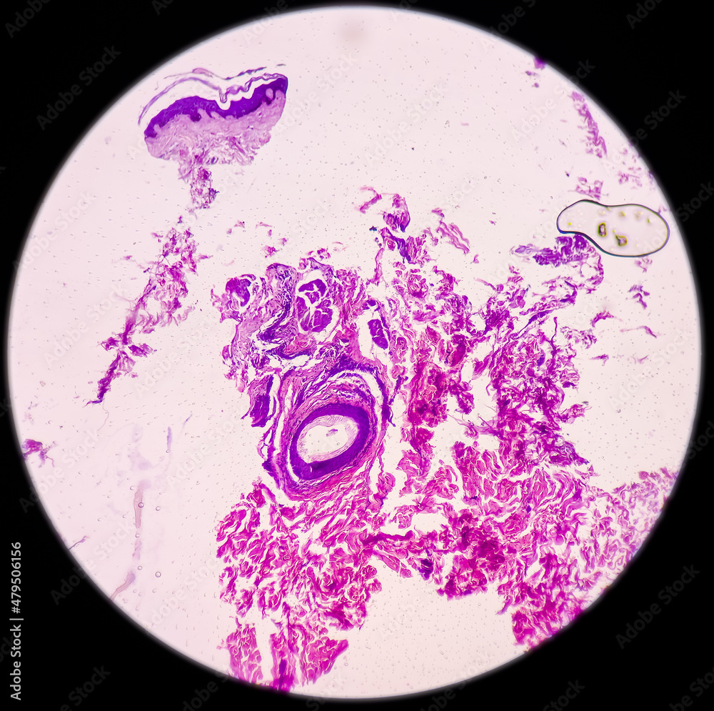 Chest Wall Cystbiopsy Epidermal Inclusion Cyst Commonly Called Sebaceous Cyst Showing
