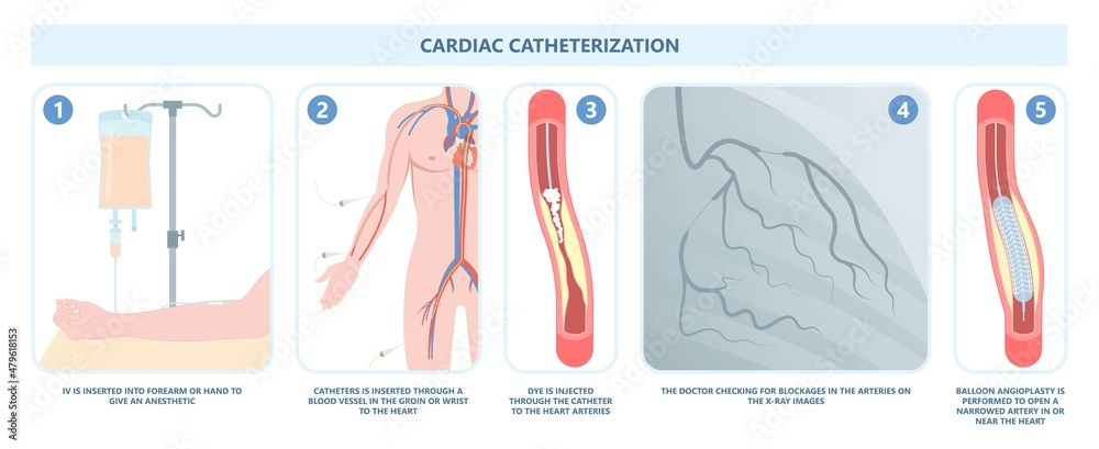 Angiography medical operation Angiogram Biopsy Angioplasty Stent ...