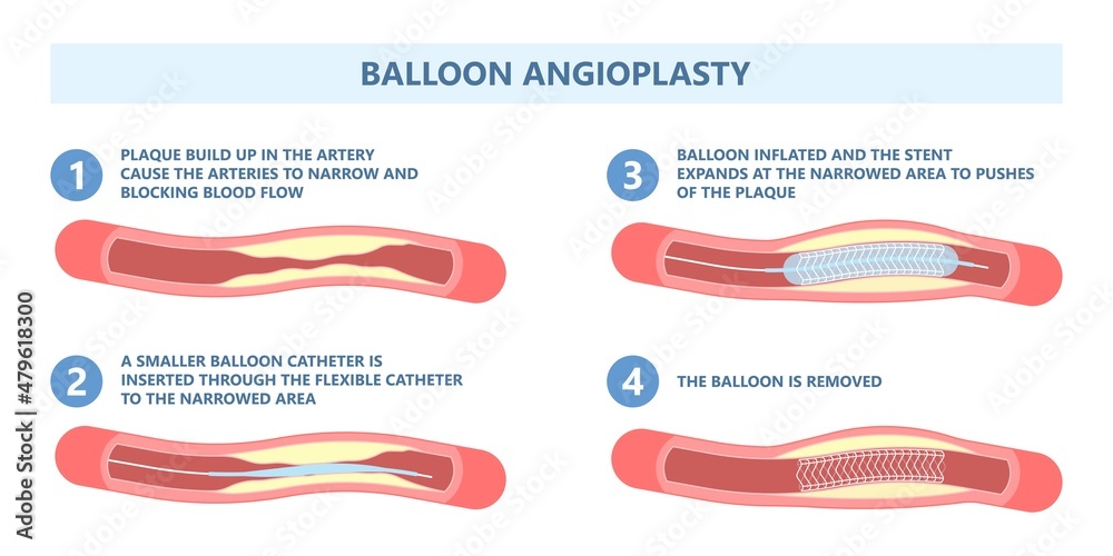 Angiography medical operation Angiogram Biopsy Angioplasty Stent ...