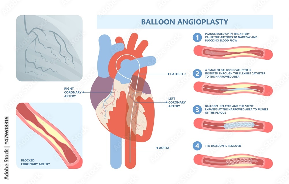 Angiography medical operation Angiogram Biopsy Angioplasty Stent ...