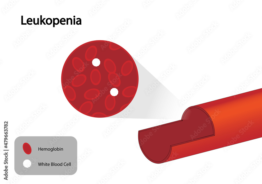 Leukopenia illustration in a sample of blood vessel. White blood cells ...