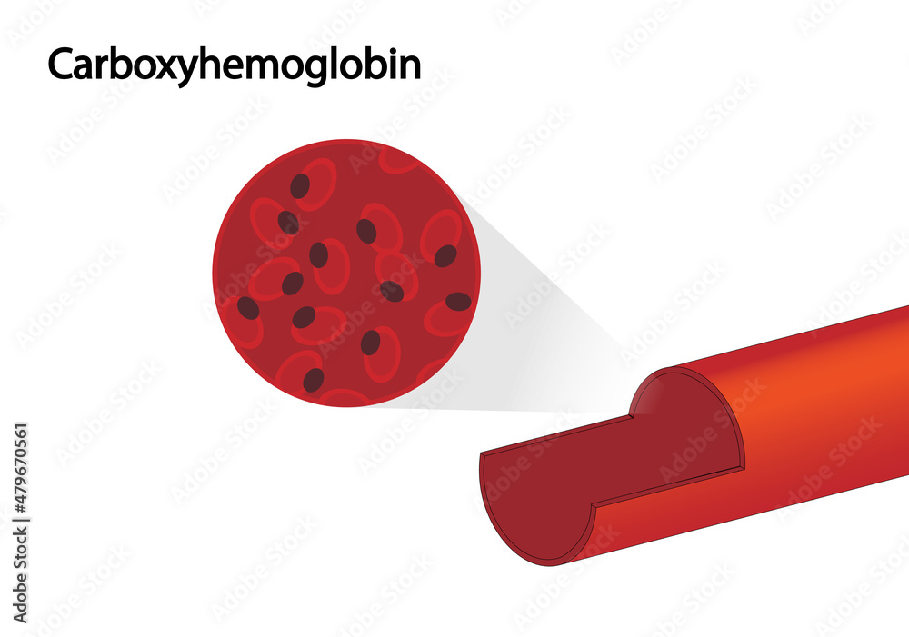 Carboxihemoglobin representation in a blood vessel Stock Illustration ...