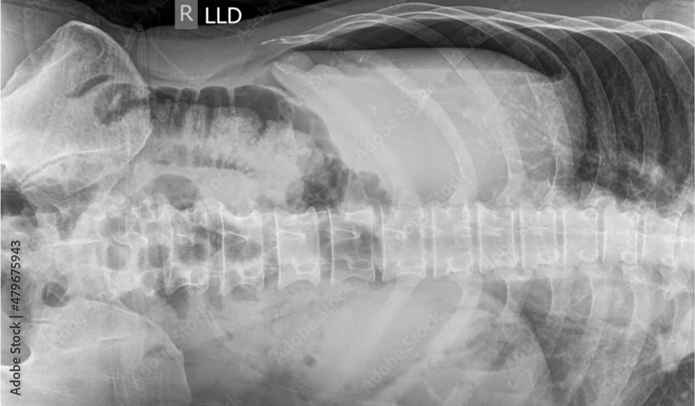 x ray image of pneumoperitoneum ,intra abdominal organ perforation ...