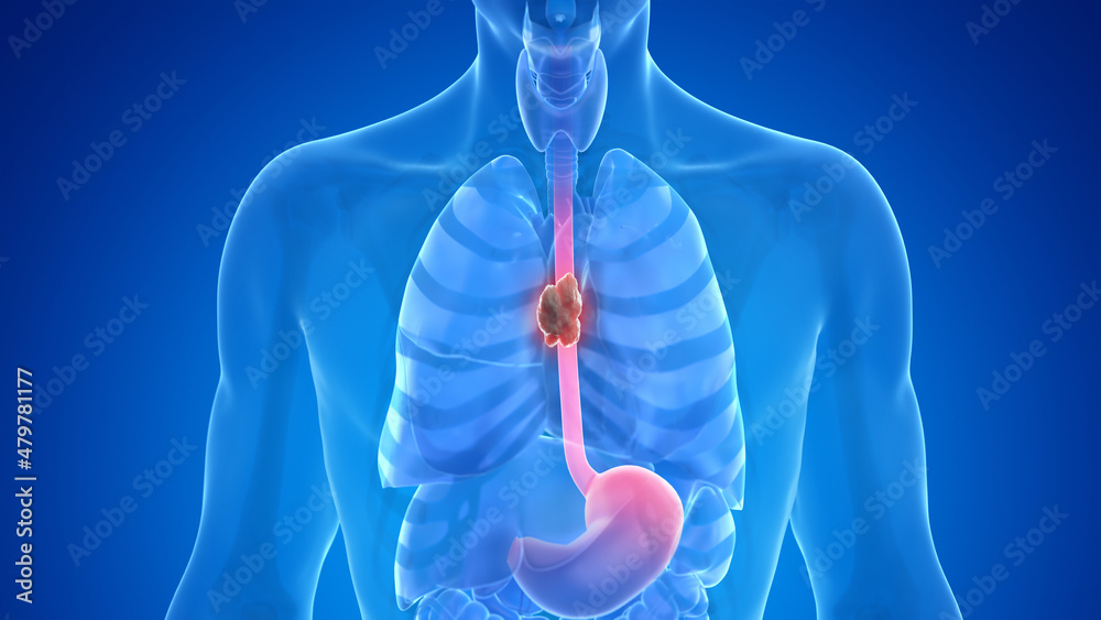 3d rendered medically accurate illustration of esophagus cancer Stock ...