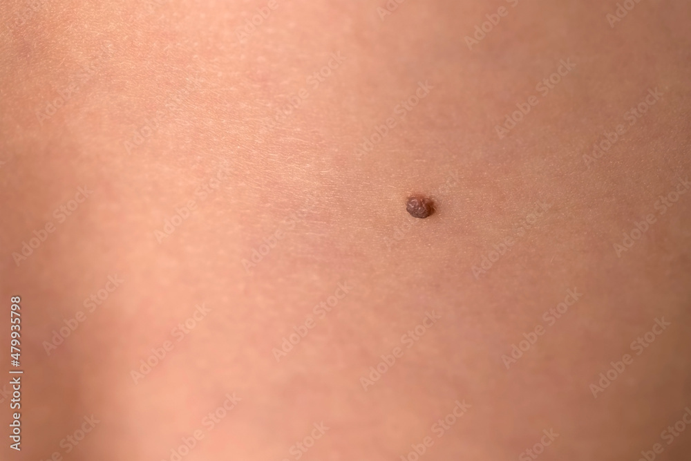 Birthmark, melanoma and nevus on teen's skin. Boy's white skin in back ...