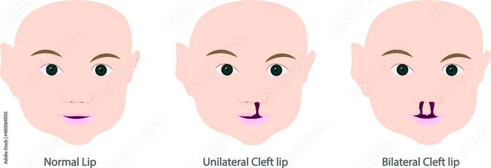 Children with Cleft Lip, unilateral and bilateral illustration. Stock ...