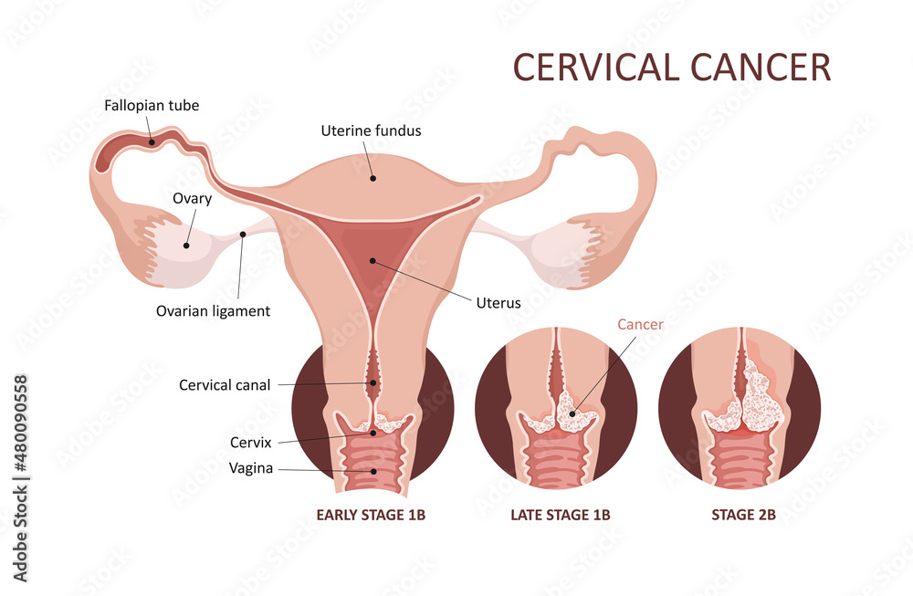 Cervical Cancer Development Image Cervix Carcinoma Stages Female
