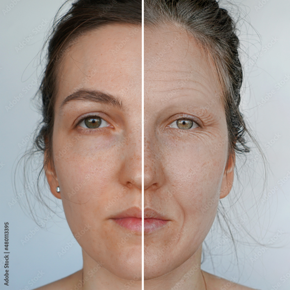 Comparison. Portrait of a beautiful woman before and after the disease ...